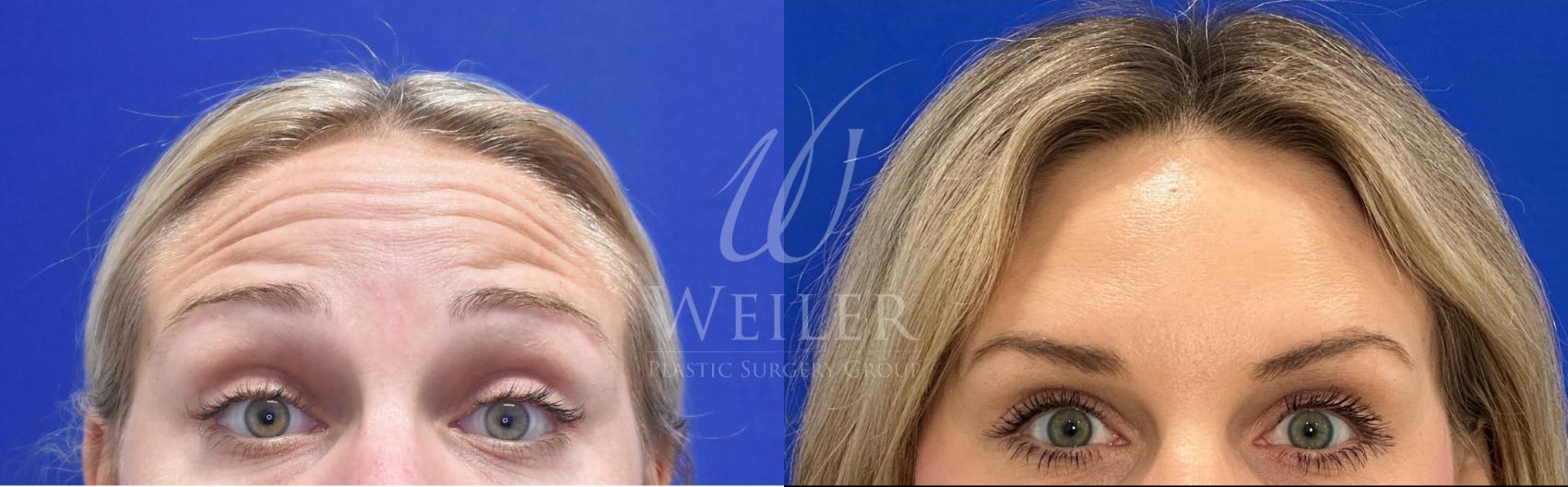 BOTOX® Cosmetic Before and After Pictures Case 1540 | Baton Rouge, New ...