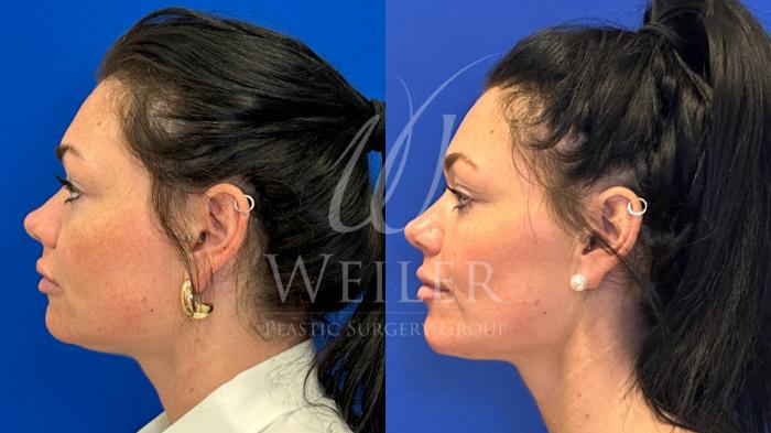 Chin Augmentation Before and After Pictures Case 1584 | Baton Rouge ...