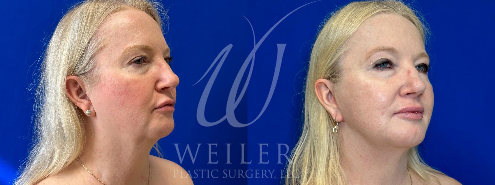 Facelift Before and After Pictures Case 1044 | Baton Rouge, New Orleans, & Lafayette, Louisiana ...