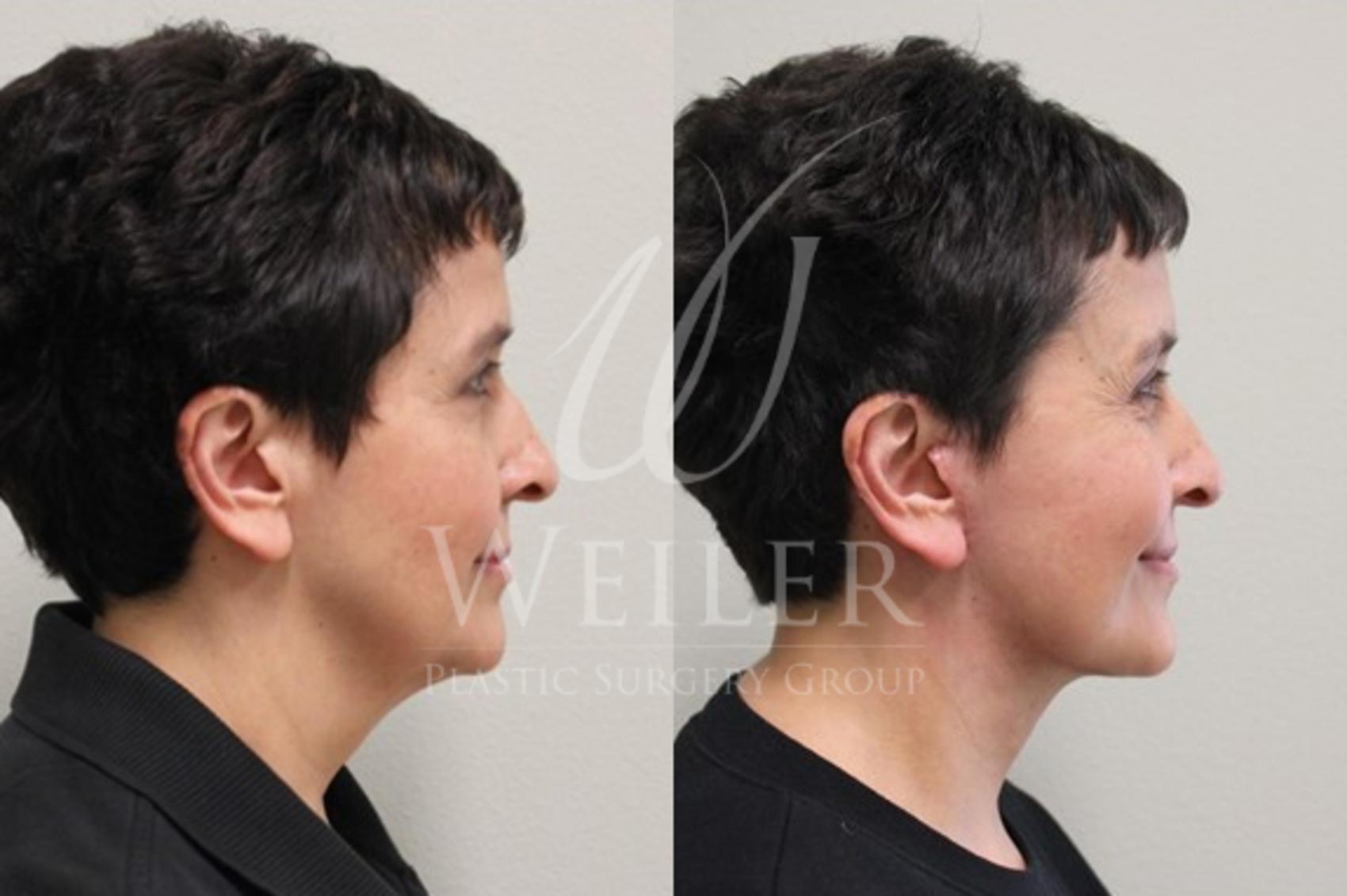 Facelift Before and After Pictures Case 33 | Baton Rouge, New Orleans, & Lafayette, Louisiana ...