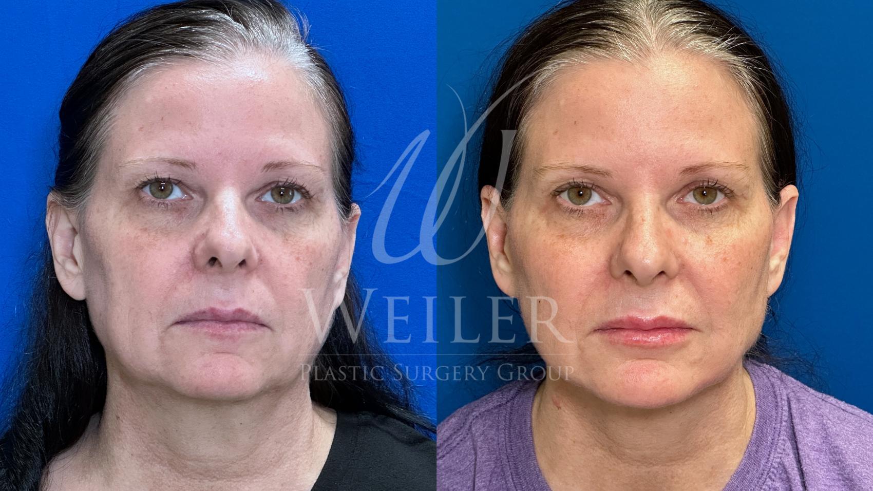 Facial Balancing Before and After Pictures Case 1453 | Baton Rouge, New ...