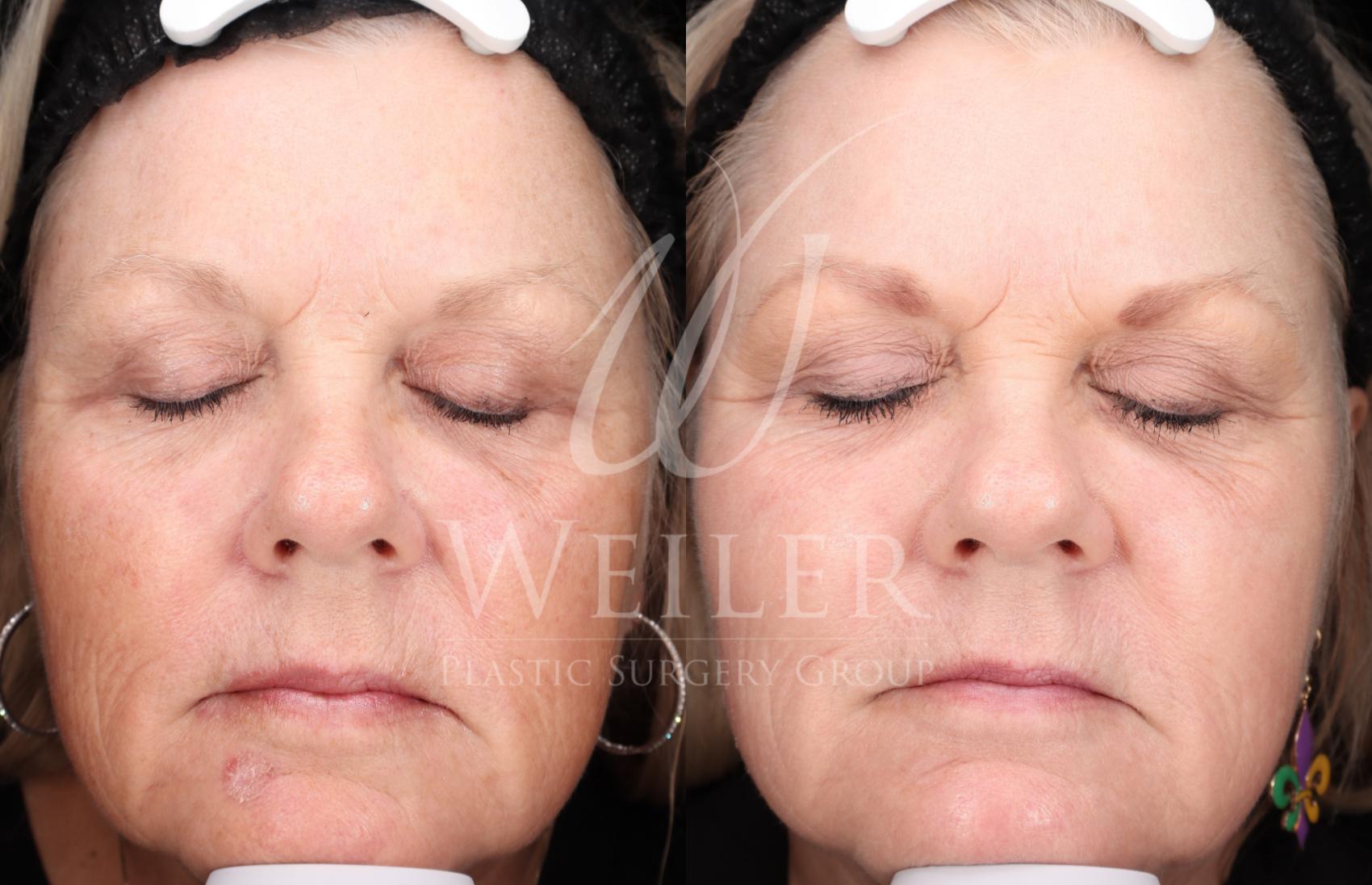 Lutronic Ultra™ Laser Before and After Pictures Case 1435 | Baton Rouge ...