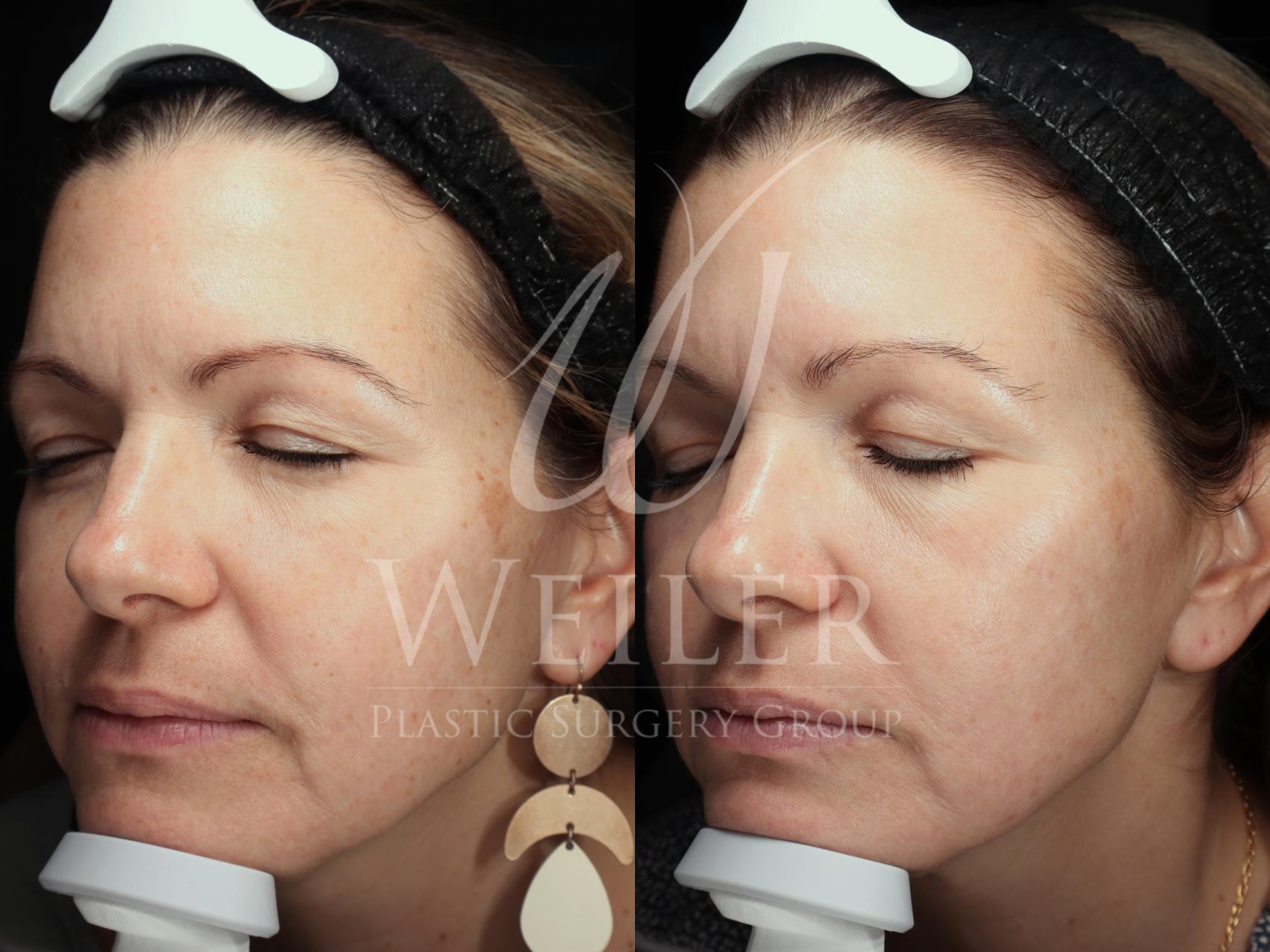 Lutronic Ultra™ Laser Before and After Pictures Case 1484 | Baton Rouge ...