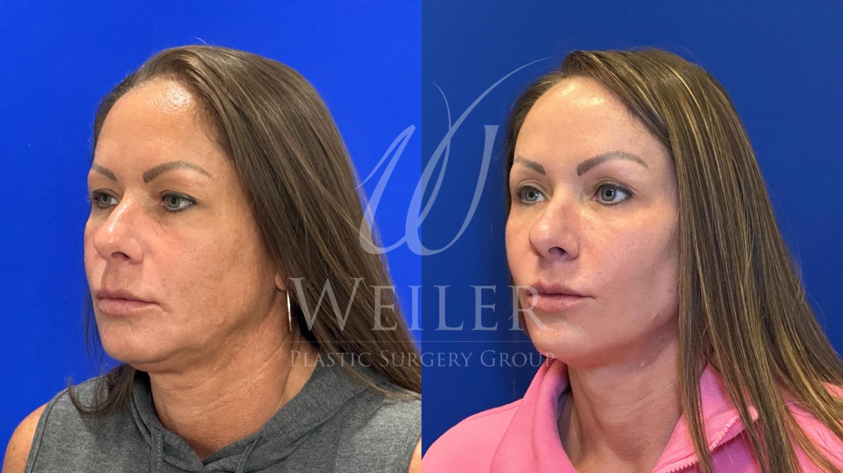 Midface Before and After Pictures Case 1439 | Baton Rouge, New Orleans ...