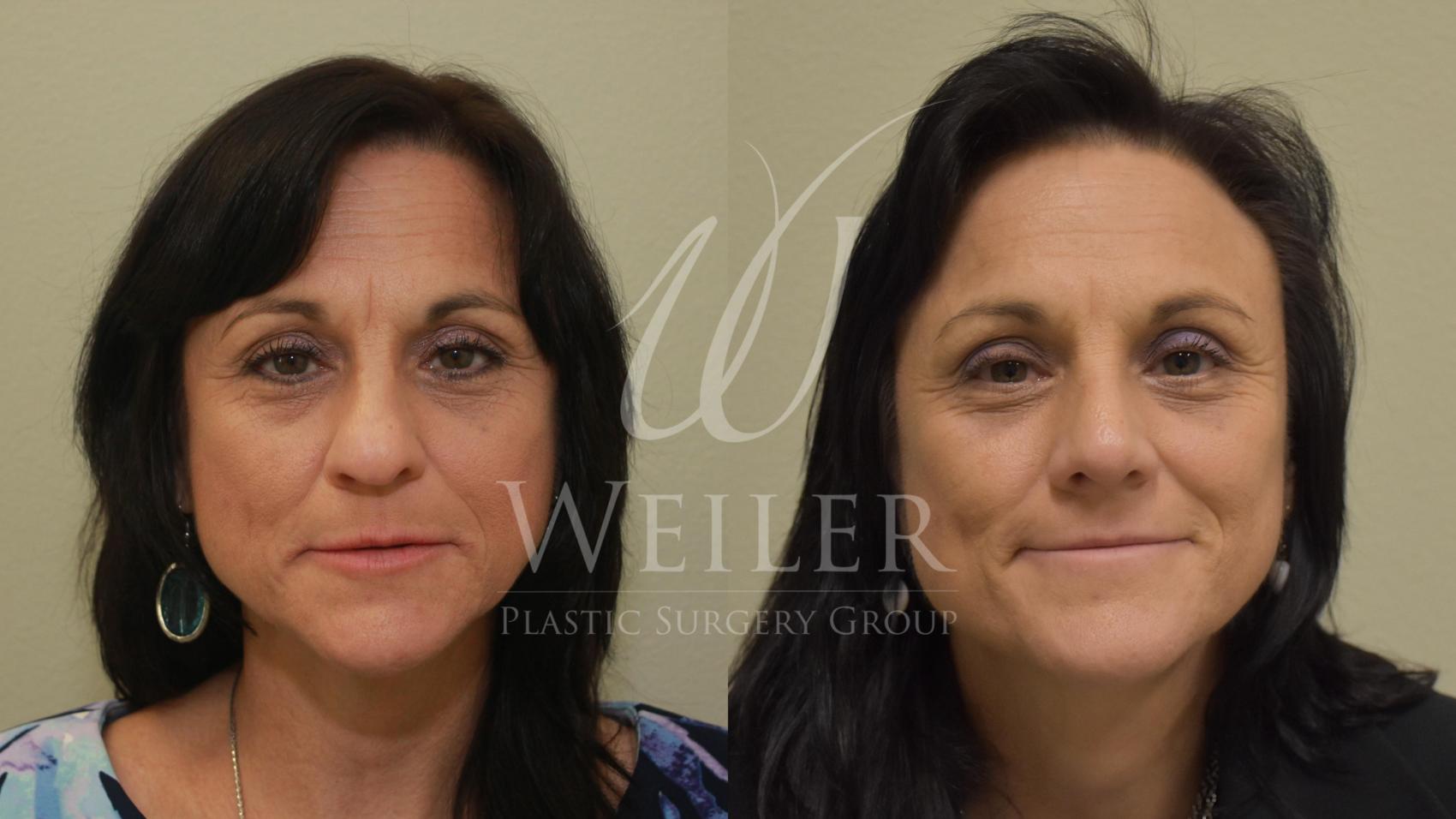 Rhinoplasty Before and After Pictures Case 272 | Baton Rouge, New Orleans, & Lafayette ...