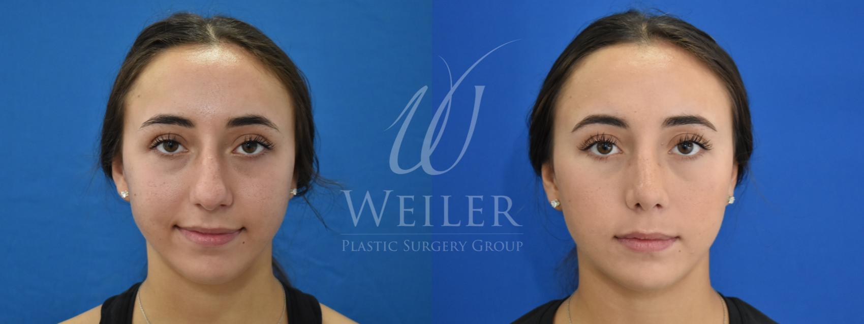 Rhinoplasty Before and After Pictures Case 881 | Baton Rouge, New Orleans, & Lafayette ...