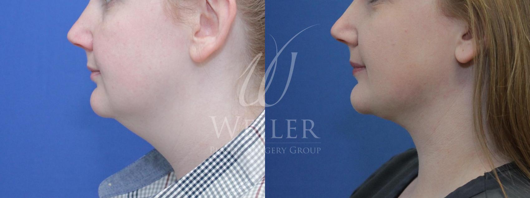 Submental Liposuction Before and After Pictures Case 657 | Baton Rouge ...